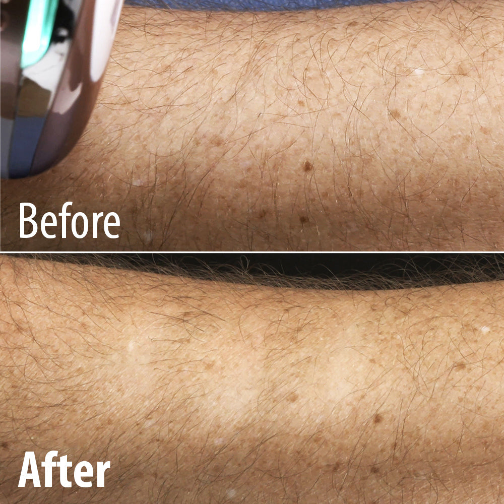3PL Beauty Treatment System – Thin Lizzy